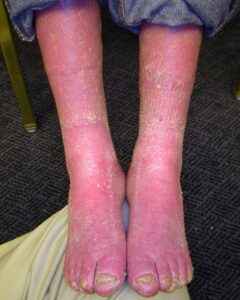 Harlequin Ichthyosis - FIRST - Foundation for Ichthyosis & Related Skin ...